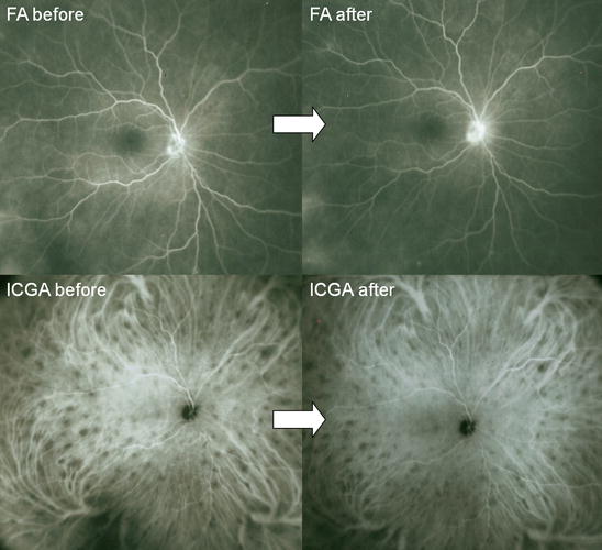 Indocyanine green angiography-guided management of Vogt–Koyanagi–Harada ...