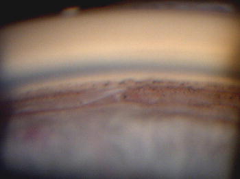 Washout of pseudoexfoliation material combined with cataract surgery: a ...