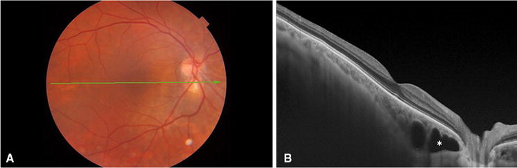 Optical coherence tomography and pathological myopia: an update of the ...