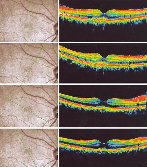 Recurrent focal choroidal excavation following multiple evanescent ...