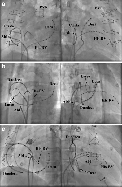 Usefulness of a crista catheter for 3-dimensional electroanatomical ...