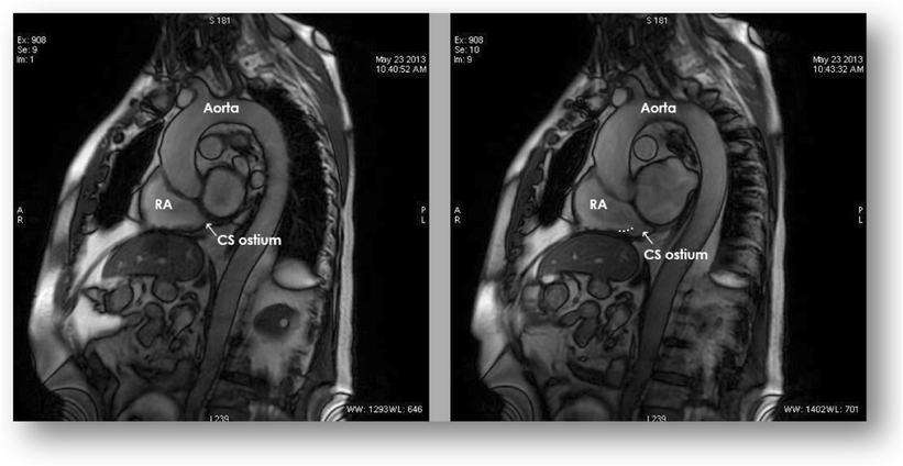 The Thebesian valve and coronary sinus in cardiac magnetic resonance ...