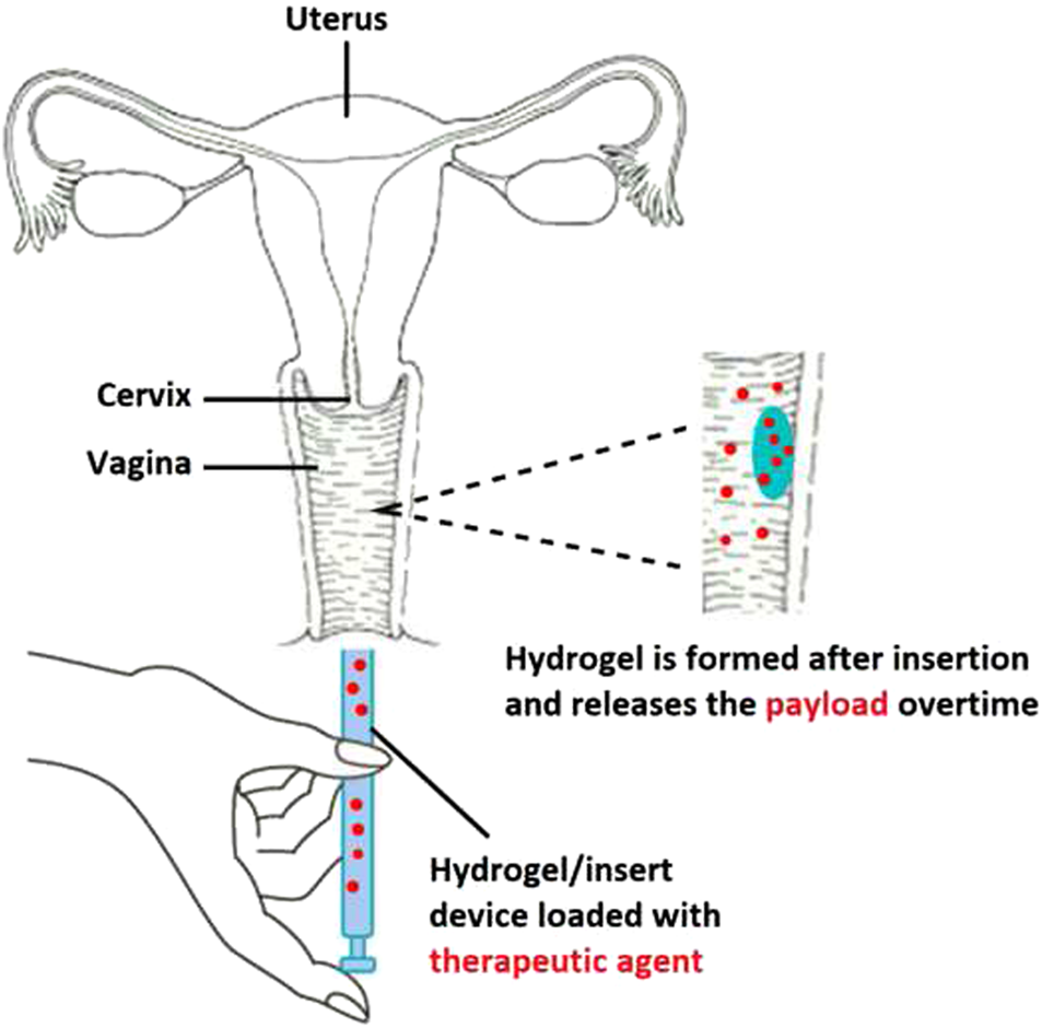 In situ-forming and pH-responsive hydrogel based on chitosan for ...