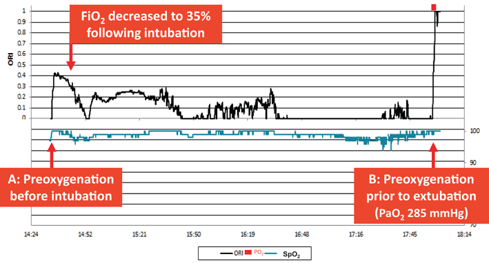 The oxygen reserve index (ORI): a new tool to monitor oxygen therapy ...