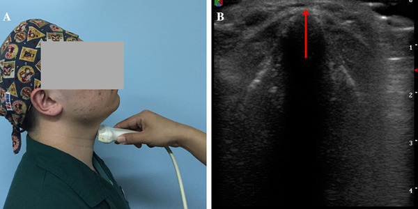 Can thyromental distance be measured accurately? | SpringerLink