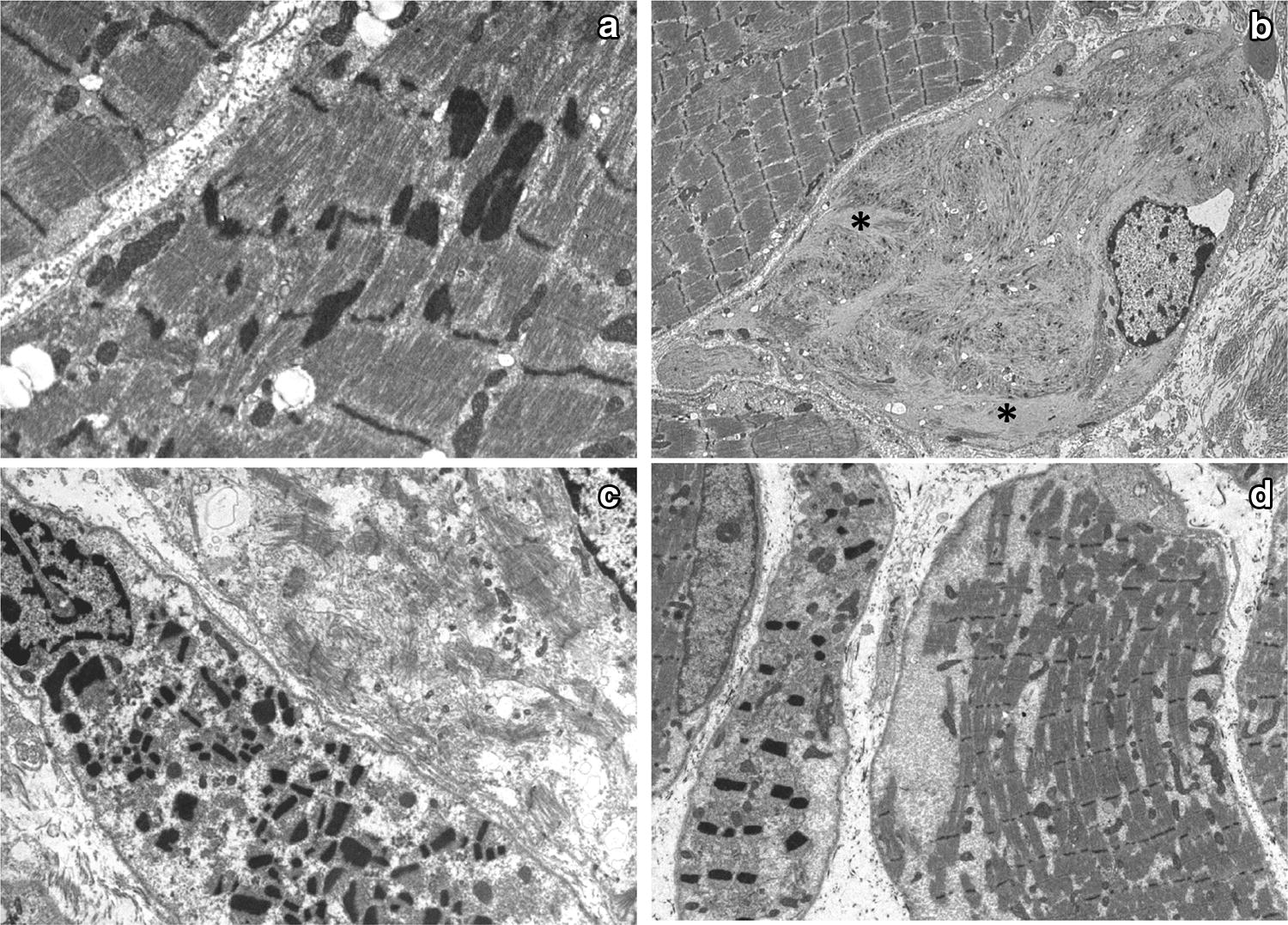 Nemaline myopathies: a current view | SpringerLink