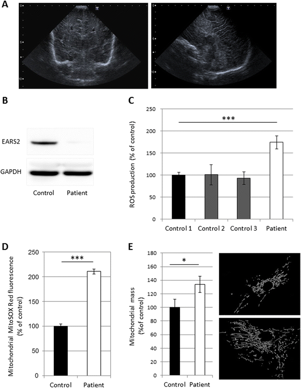 EARS2 mutations cause fatal neonatal lactic acidosis, recurrent ...