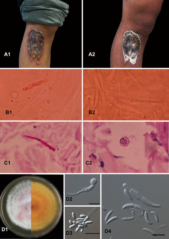 The Concept of Ecthyma Gangrenosum Illustrated by a Fusarium oxysporum ...