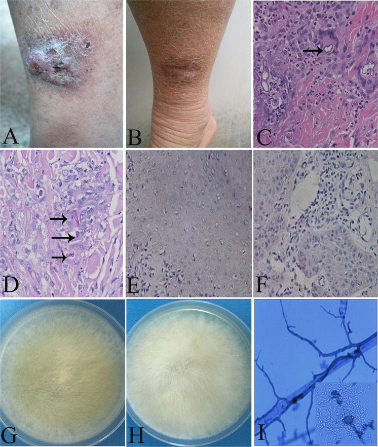 Successful Treatment by Surgery of a Primary Cutaneous Mucormycosis ...