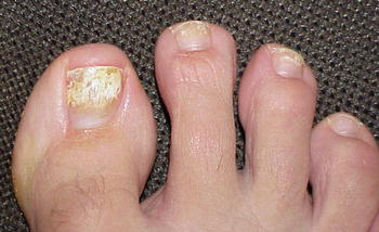 A Review of Onychomycosis Due to Aspergillus Species | SpringerLink