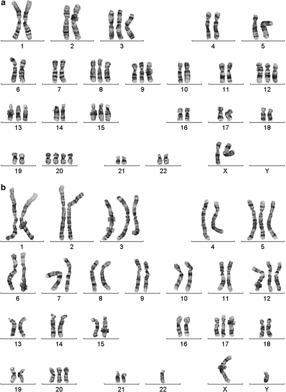 Hyperdiploidy defines a distinct cytogenetic entity of meningiomas ...