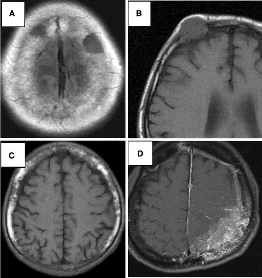 Metastatic skull tumors: MRI features and a new conventional ...