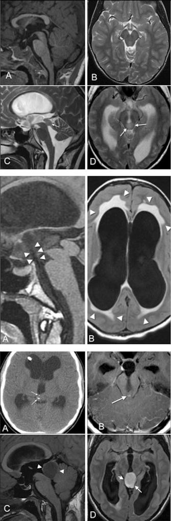 Pediatric tectal plate gliomas: a review of clinical outcomes ...