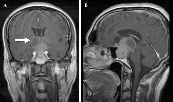 Unusual clinical presentations of giant prolactinomas | SpringerLink