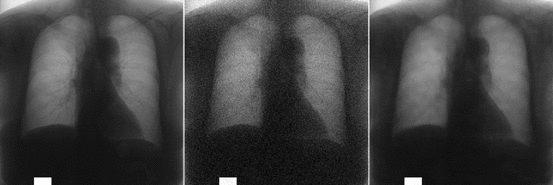 Medical image denoising using convolutional neural network: a residual learning approach ...