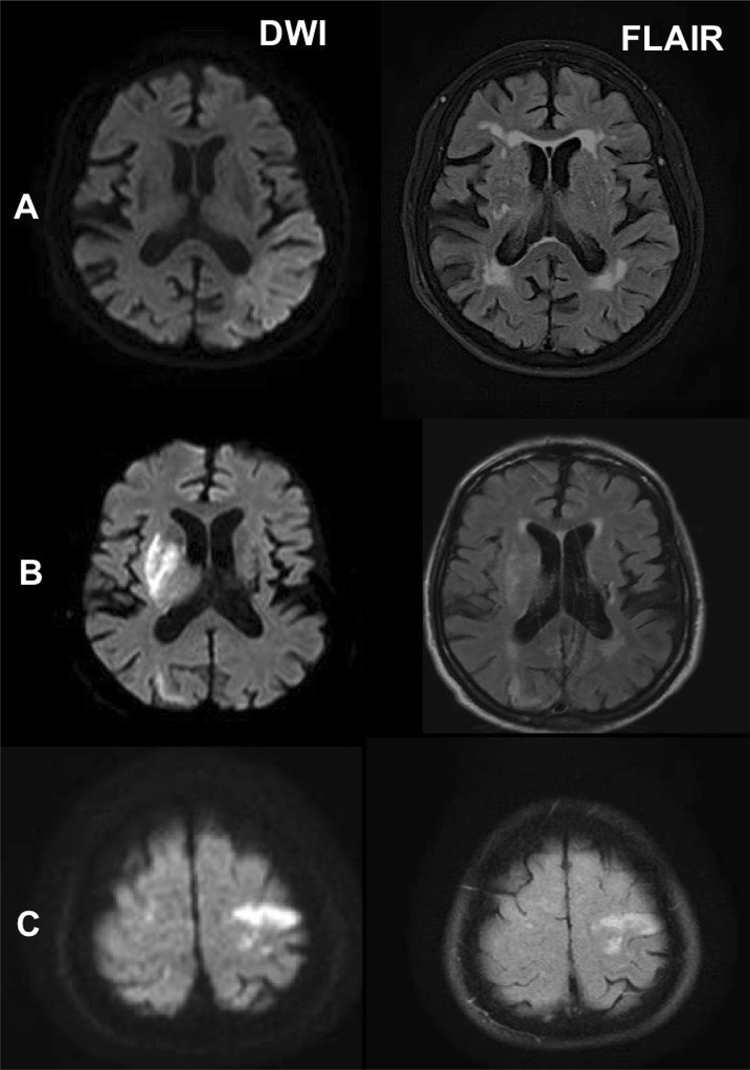 Modified DWI-FLAIR mismatch guided thrombolysis in unknown onset stroke ...