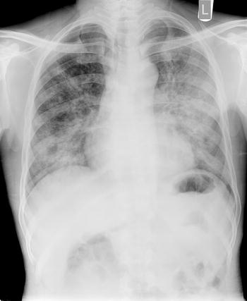 Bronchiolitis obliterans organizing pneumonia (BOOP) after renal transplantation | SpringerLink