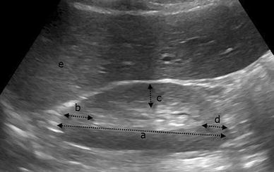 Role of ultrasonographic chronic kidney disease score in the assessment ...