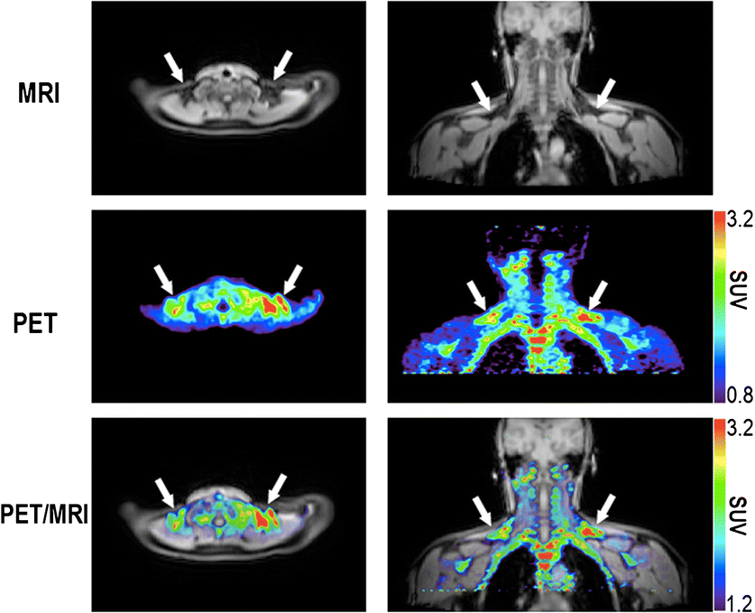 PET Imaging of Human Brown Adipose Tissue with the TSPO Tracer [11C ...