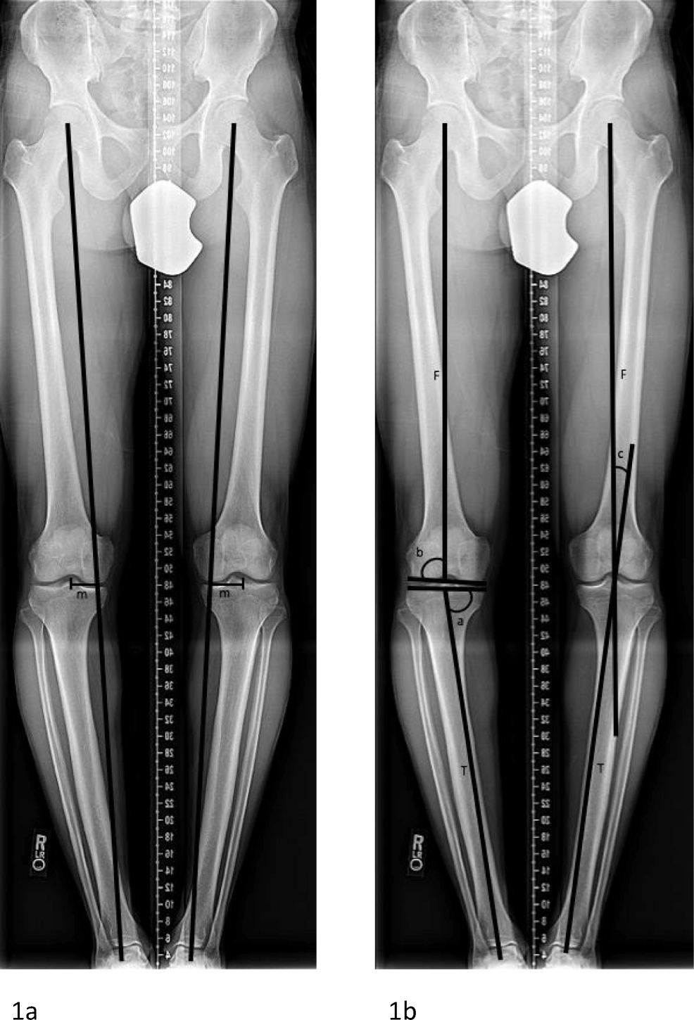 Biomechanical and Functional Improvements Gained by Proximal Tibia ...
