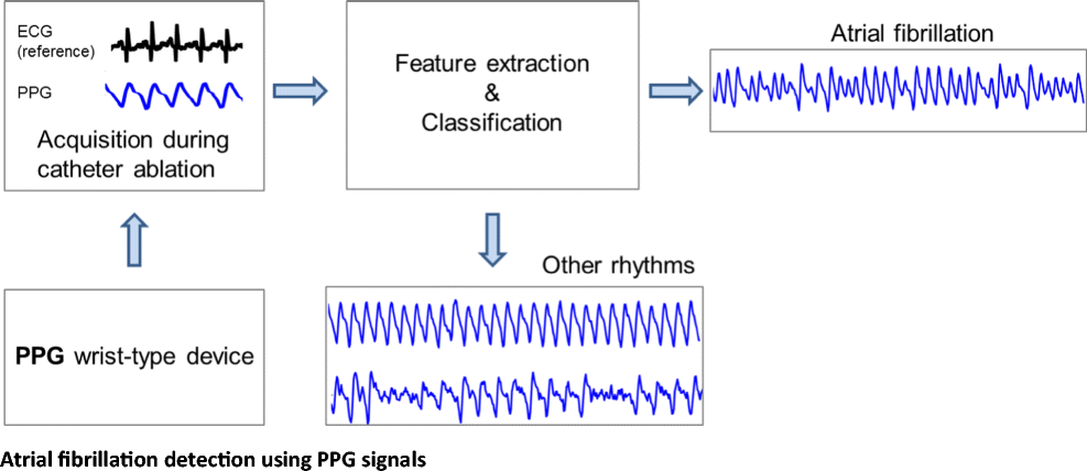 Can one detect atrial fibrillation using a wrist-type ...