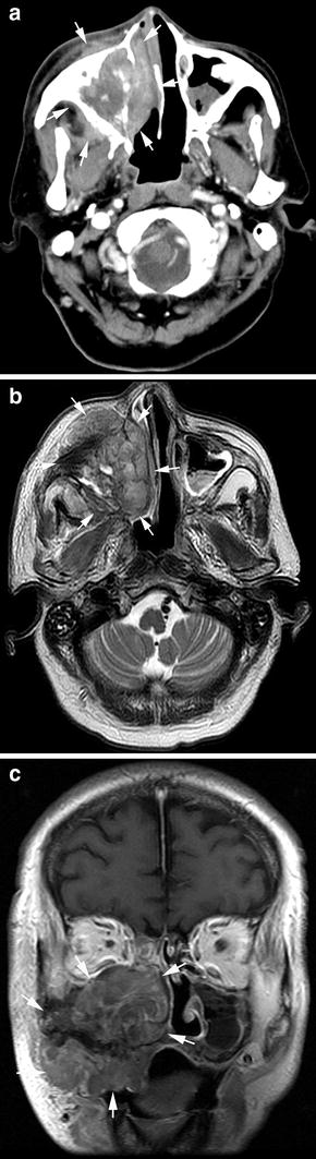 Radiation-induced sarcomas of the head and neck in post-radiation ...
