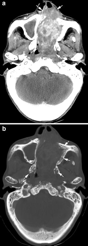 Radiation-induced sarcomas of the head and neck in post-radiation ...