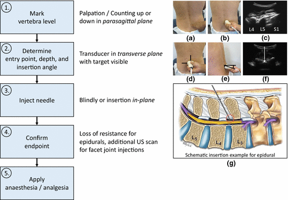 Towards real-time, tracker-less 3D ultrasound guidance for spine ...