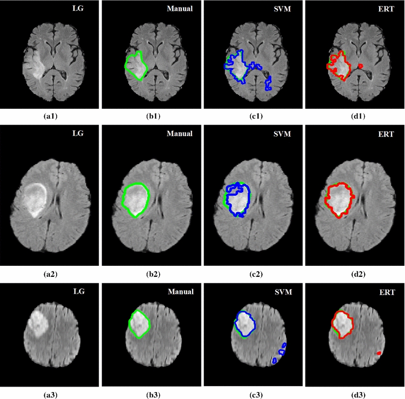 Brain Tumor Classification Matlab Code Brain Tumor Cancer