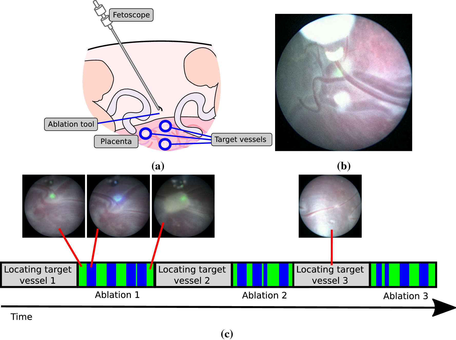 Towards computer-assisted TTTS: Laser ablation detection for workflow ...