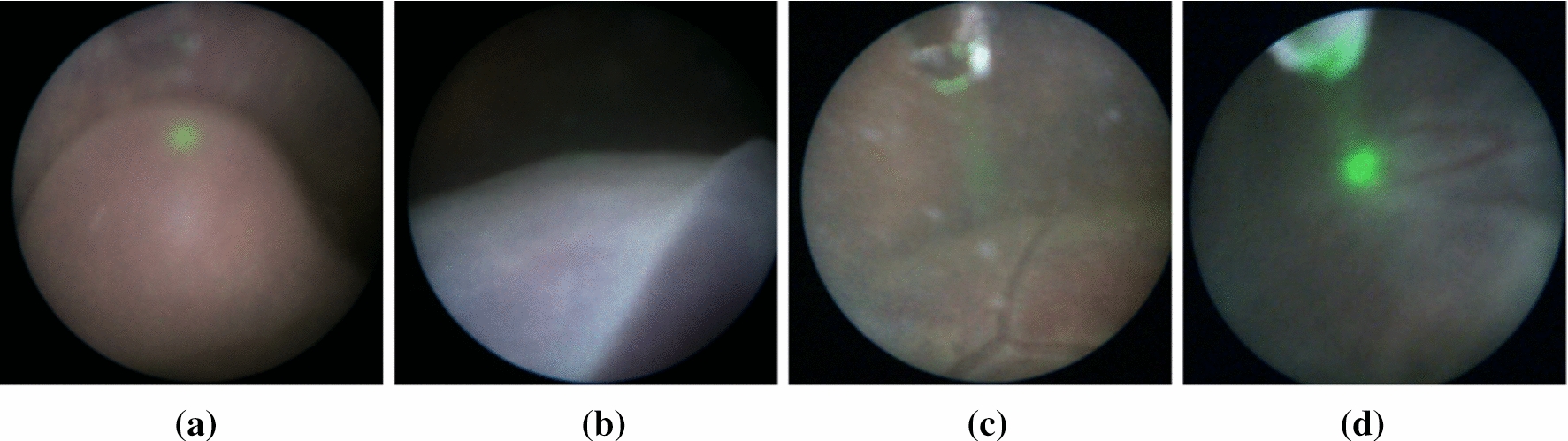 Towards computer-assisted TTTS: Laser ablation detection for workflow ...