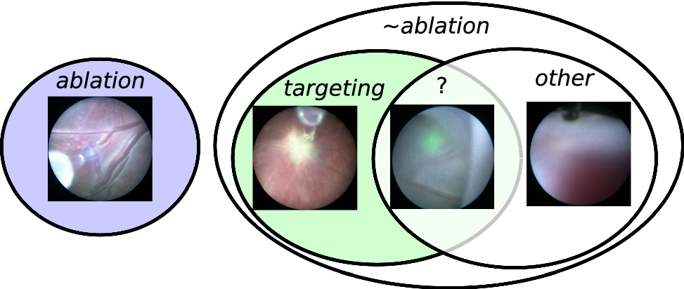 Towards computer-assisted TTTS: Laser ablation detection for workflow ...