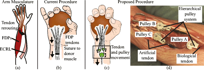Implanted passive engineering mechanism improves hand function after ...