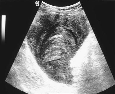 Appendiceal mucocele due to mucinous cystadenocarcinoma arising from ...