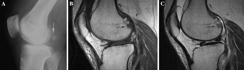 Potentially symptomatic fabella: MR imaging review | SpringerLink