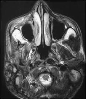 Computed tomography and magnetic resonance imaging of lesions at ...