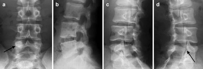 Spondylolytic spondylolisthesis: various imaging features and natural ...