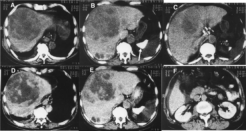 History note: tragedy of Thorotrast | SpringerLink