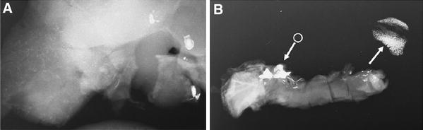 History note: tragedy of Thorotrast | SpringerLink