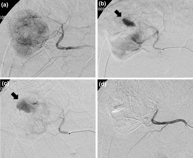 Management of vascular lake phenomenon on angiography during ...