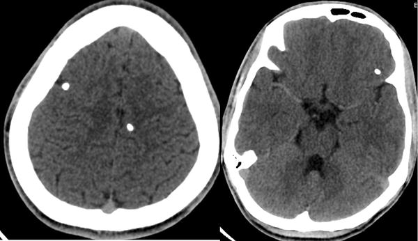 A comprehensive review of imaging findings in human cysticercosis ...