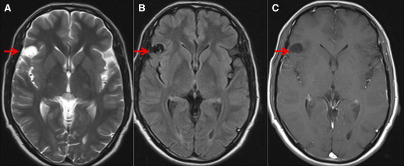 A comprehensive review of imaging findings in human cysticercosis ...