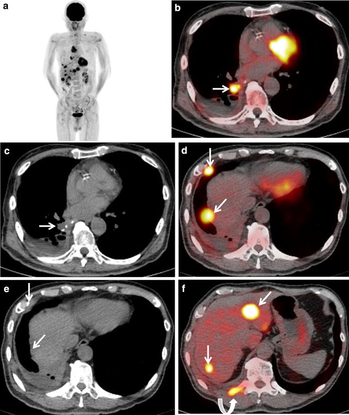 Present and future roles of FDG-PET/CT imaging in the management of ...