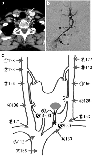 Selective venous sampling for primary hyperparathyroidism: how to ...