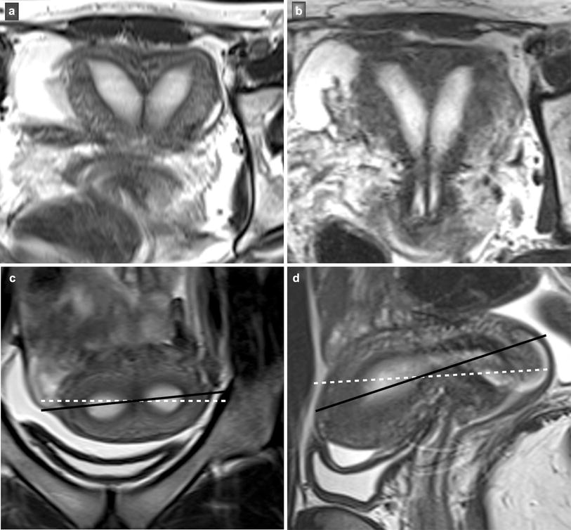 The spectrum of imaging appearances of müllerian duct anomalies: focus ...