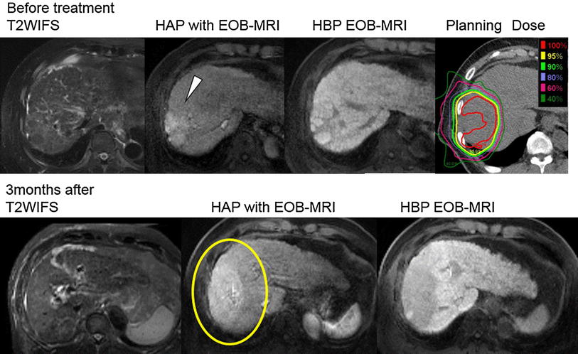 Pathology and images of radiation-induced hepatitis: a review article ...