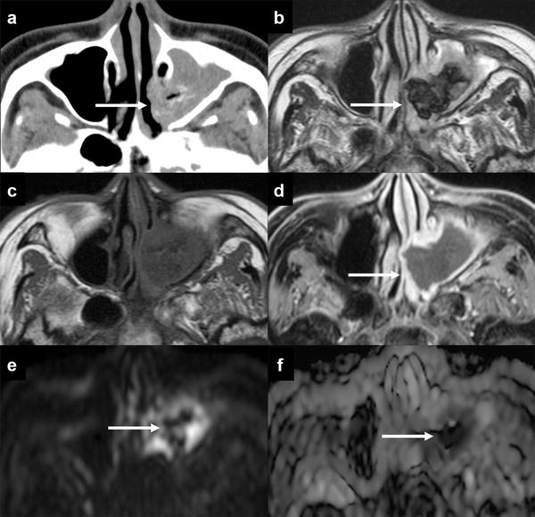 Imaging features of benign mass lesions in the nasal cavity and ...