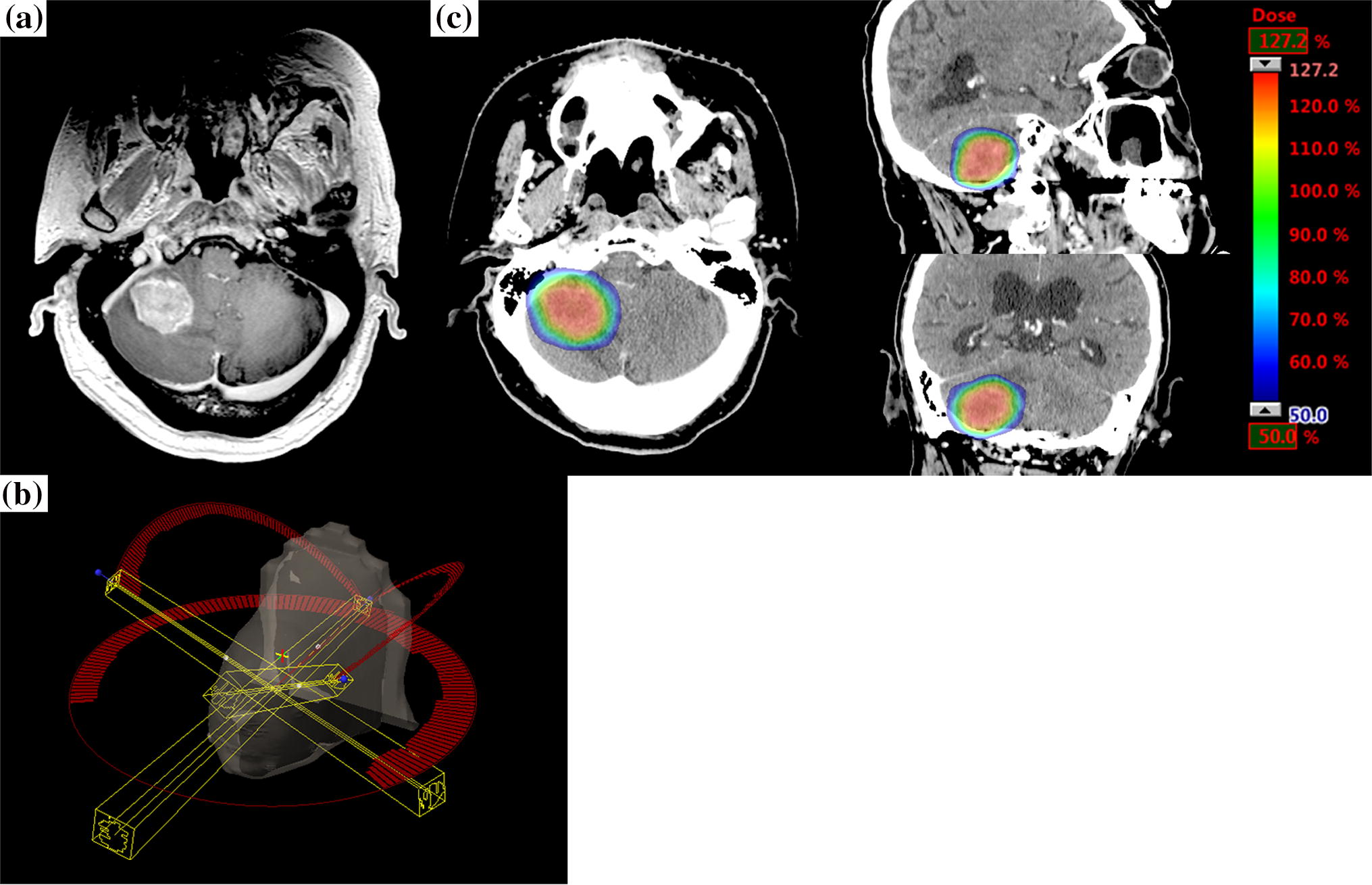 MRI appearance change during stereotactic radiotherapy for large brain ...