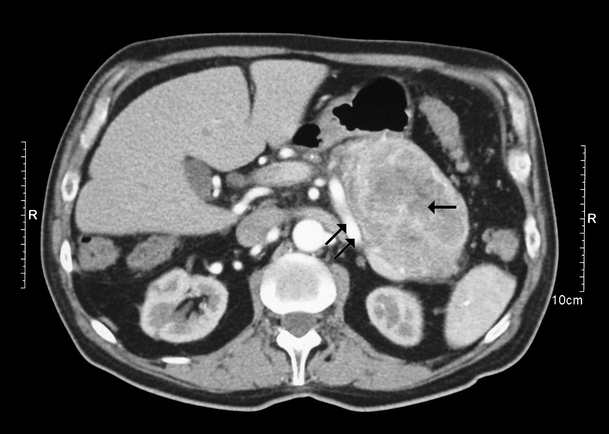 Pancreatic VIPomas: Subject Review and One Institutional Experience ...