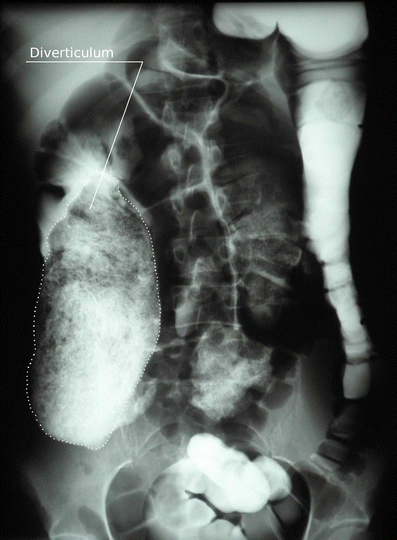 Gastrointestinal Image: A True Giant Transverse Colon Diverticulum ...